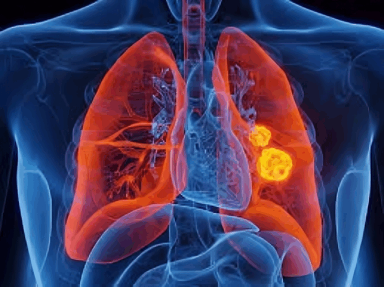 Científicos eliminan mutación clave del cáncer de pulmón con nueva ...